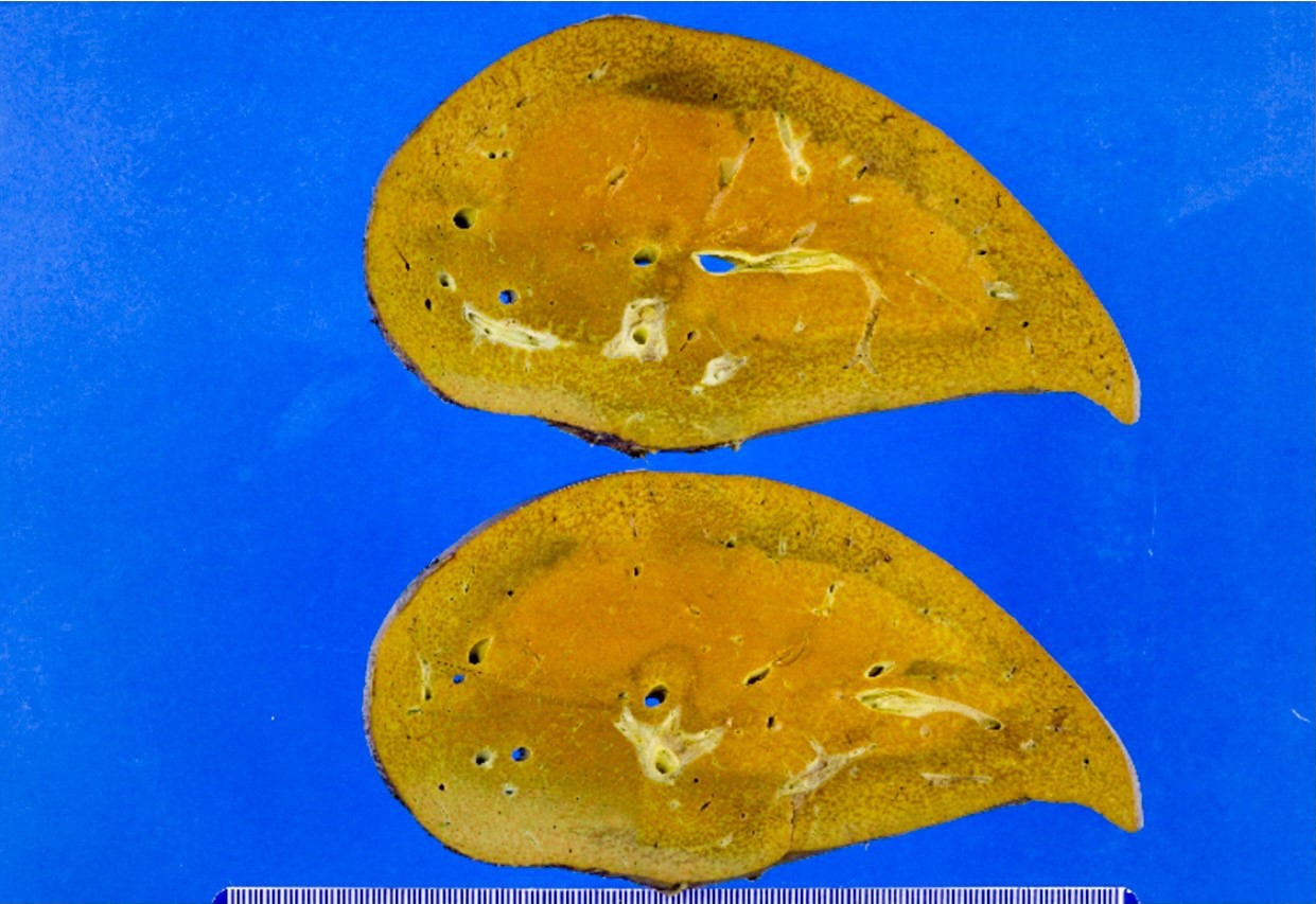 Interesting Case July 2022 – Hans Popper Hepatopathology Society